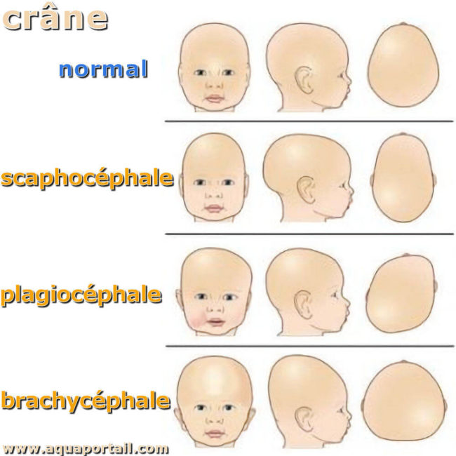 crane-enfant-normal-scaphocephale-plagiocephale-brachycephale | Laosteo